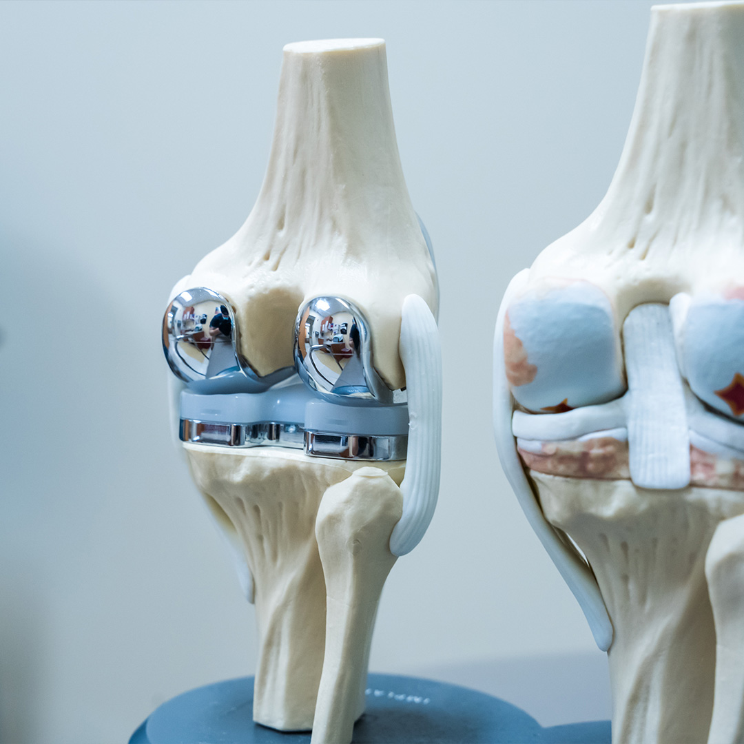 Joint Replacement - Orthopedic Partners